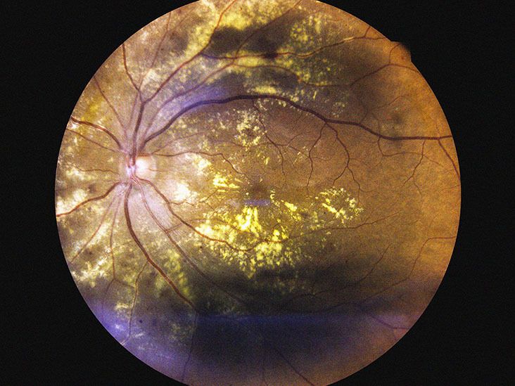 Dry Age-Related Macular Degeneration (AMD) Guide